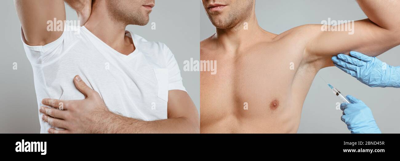 Collage of man with sweaty armpit and doctor doing botox injection from ...