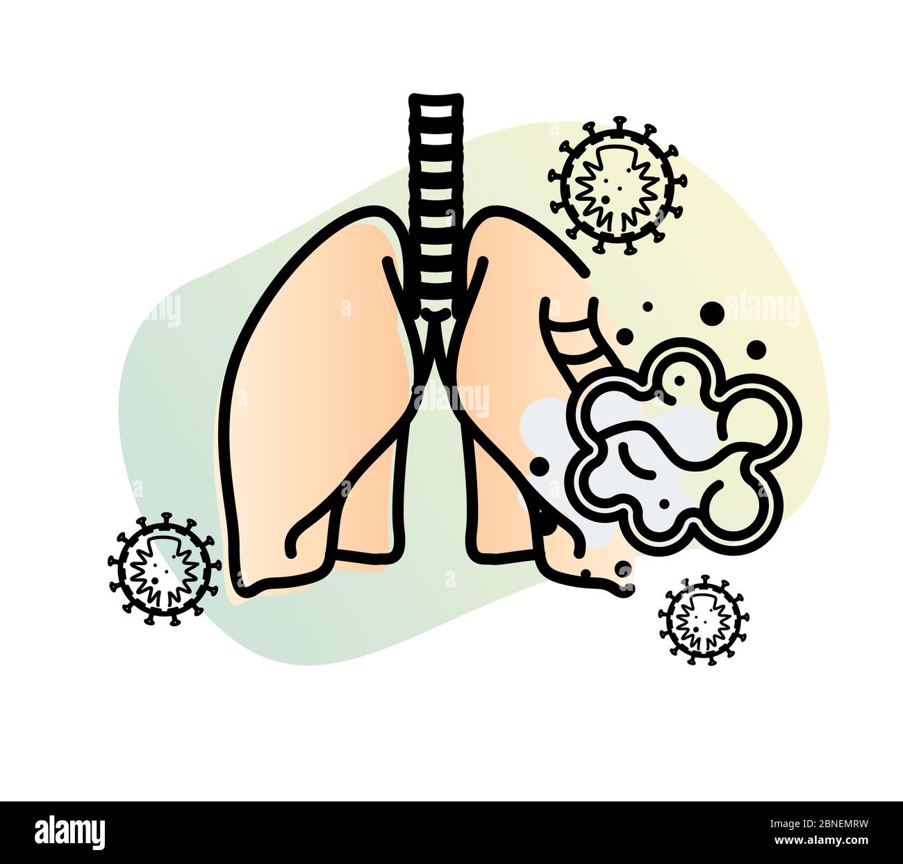 Edema vector vectors hi-res stock photography and images - Alamy