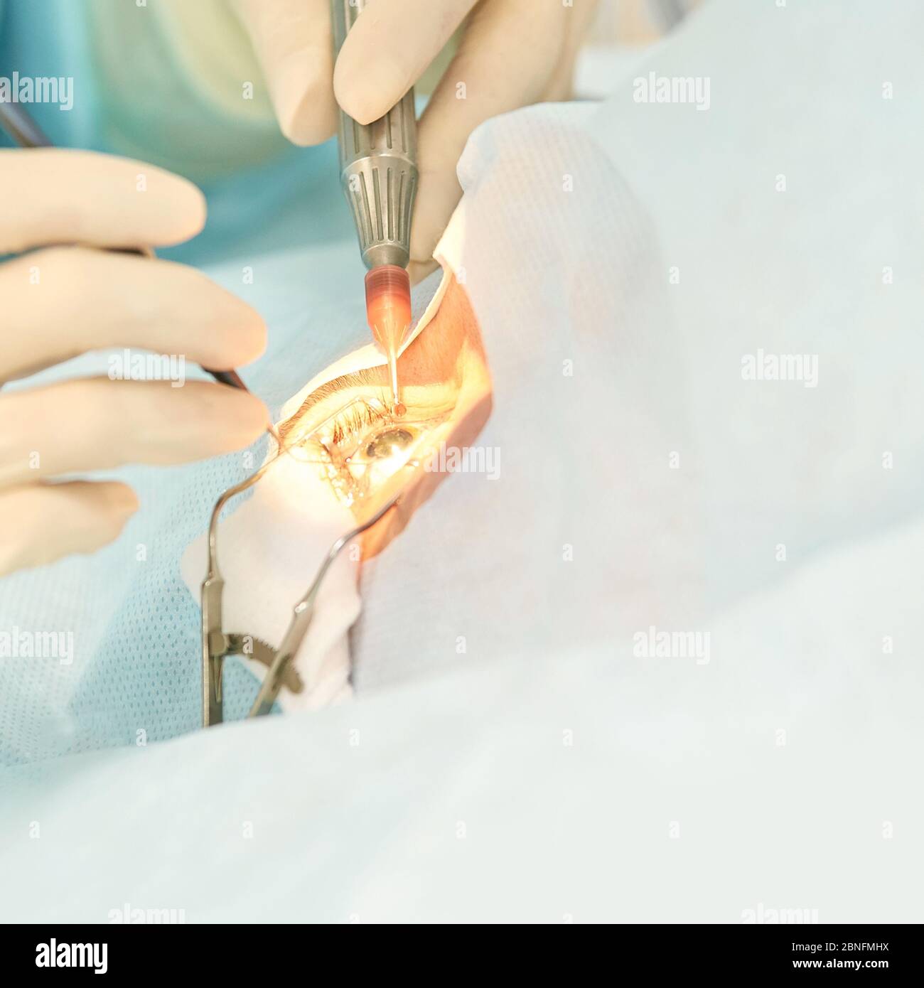 Ophthalmology laser microscope operation. Doctor in clinic. Patient eye ...