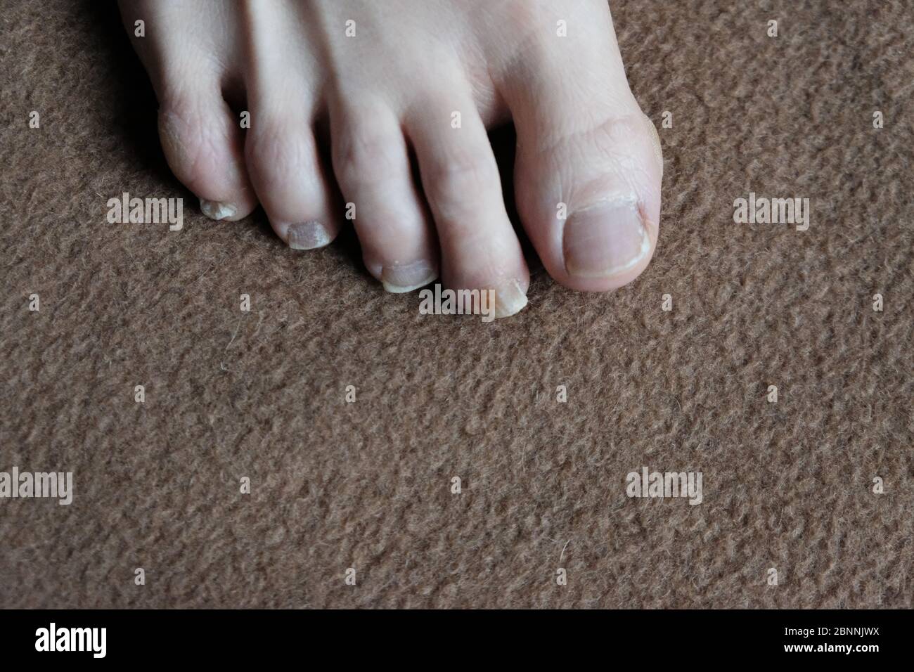 Fungal nails unsightly, thickened and crumbly, become painful within an ...