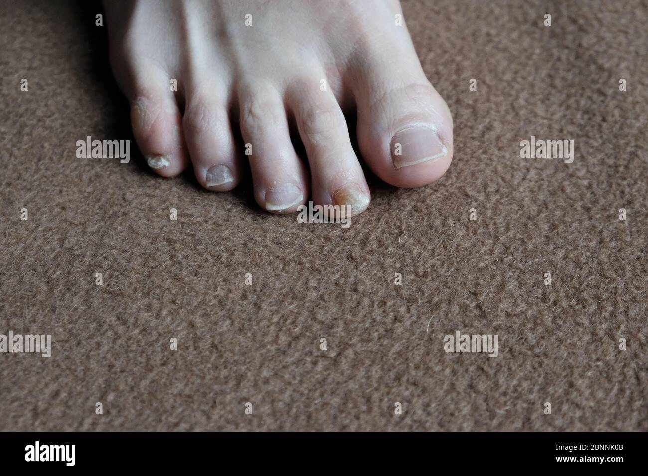 Fungal nails unsightly, thickened and crumbly, become painful within an ...