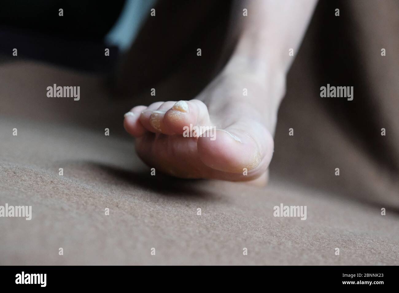 Fungal nails unsightly, thickened and crumbly, become painful within an ...