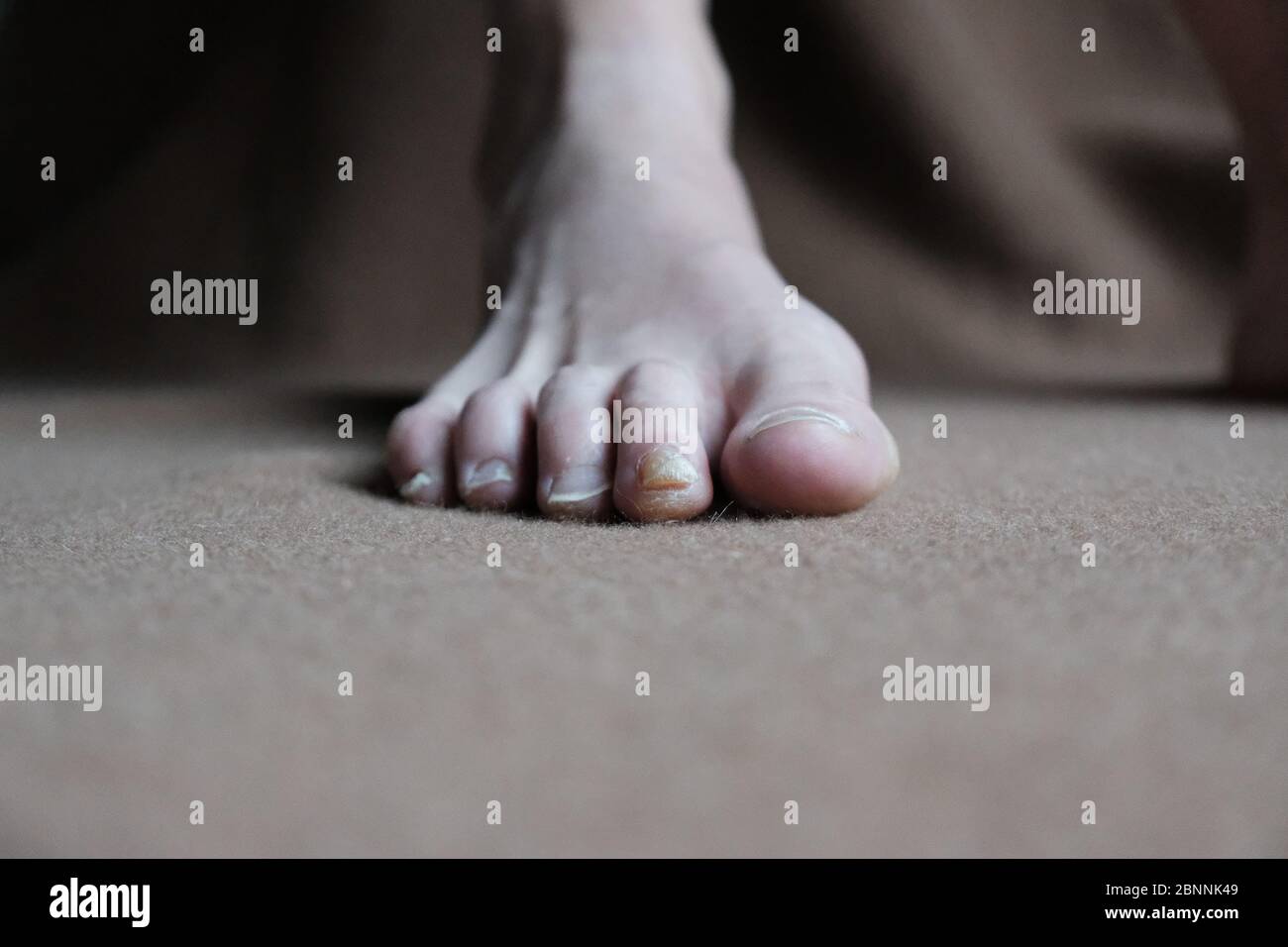 Fungal nails unsightly, thickened and crumbly, become painful within an ...