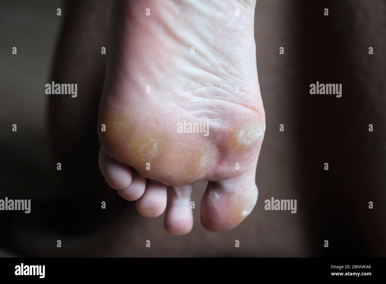 Fungal Infection Treatment Legs at Martin Green blog