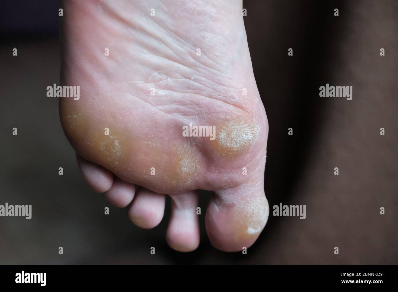 Athlete's Foot Treatment And Home Remedies, 44% OFF