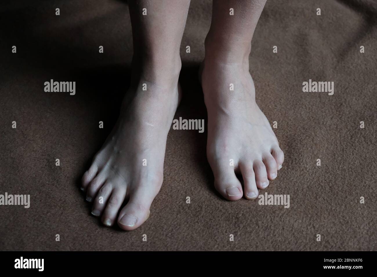 Fungal nails unsightly, thickened and crumbly, become painful within an ...