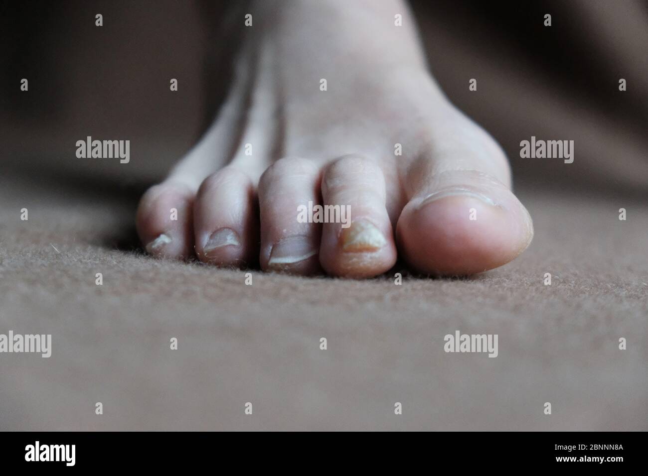 Fungal nails unsightly, thickened and crumbly, become painful within an ...