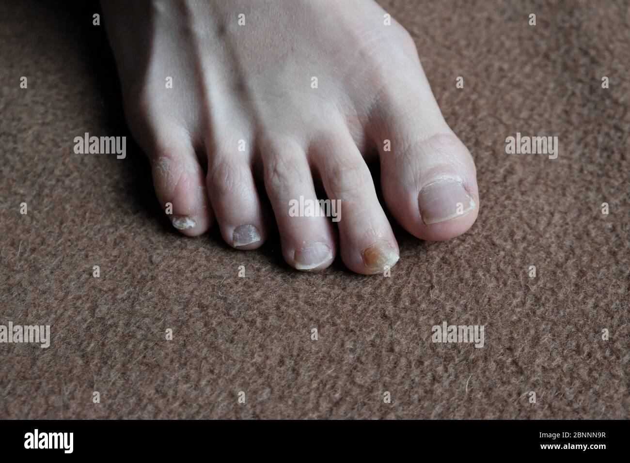 Fungal nails unsightly, thickened and crumbly, become painful within an ...