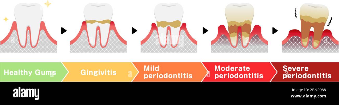 Periodontitis Stages