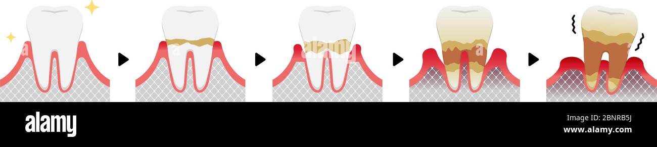 The stages of periodontitis disease vector illustration Stock Vector ...