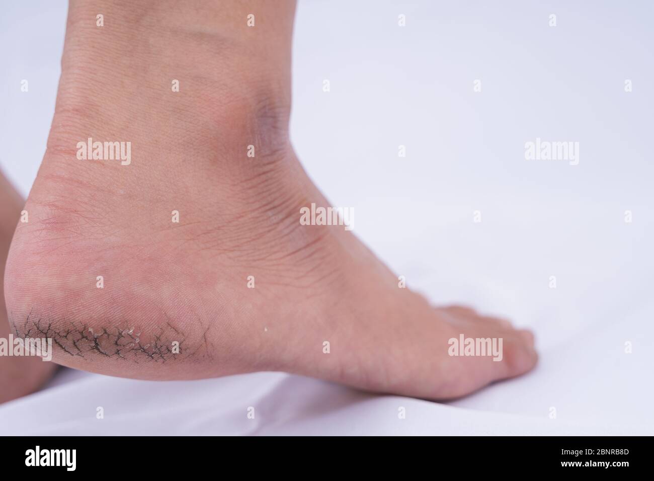 Close-up of dry and cracked heel with black bad skin on white ...