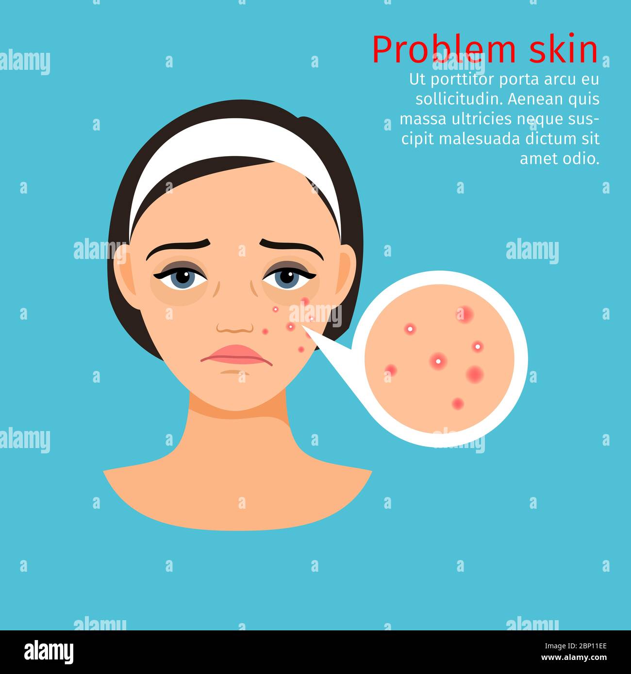 Woman face problem skin with acne, vector illustration Stock Vector ...