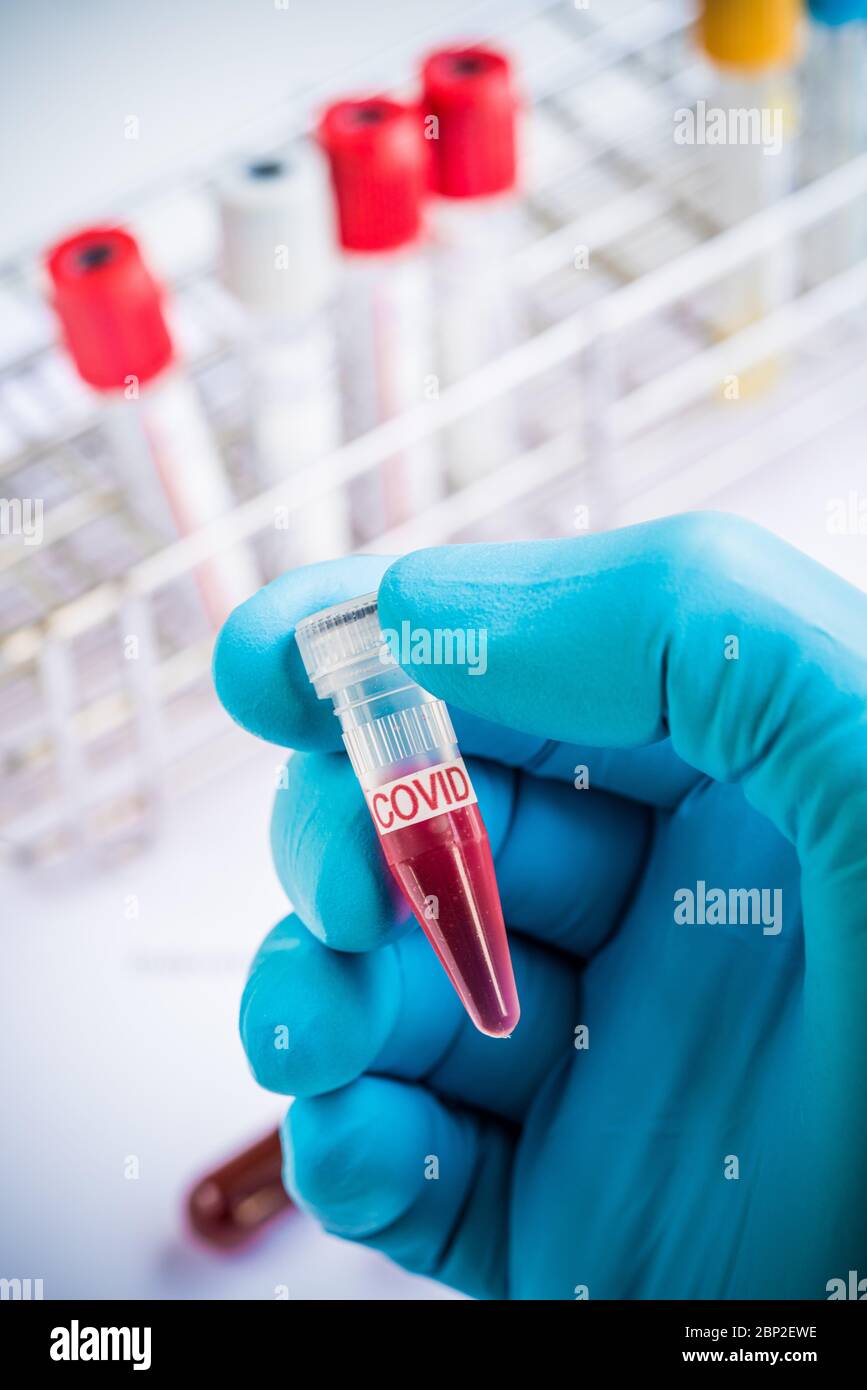 Blood sample, Covid 19 serological test of a patient wishing to know if ...