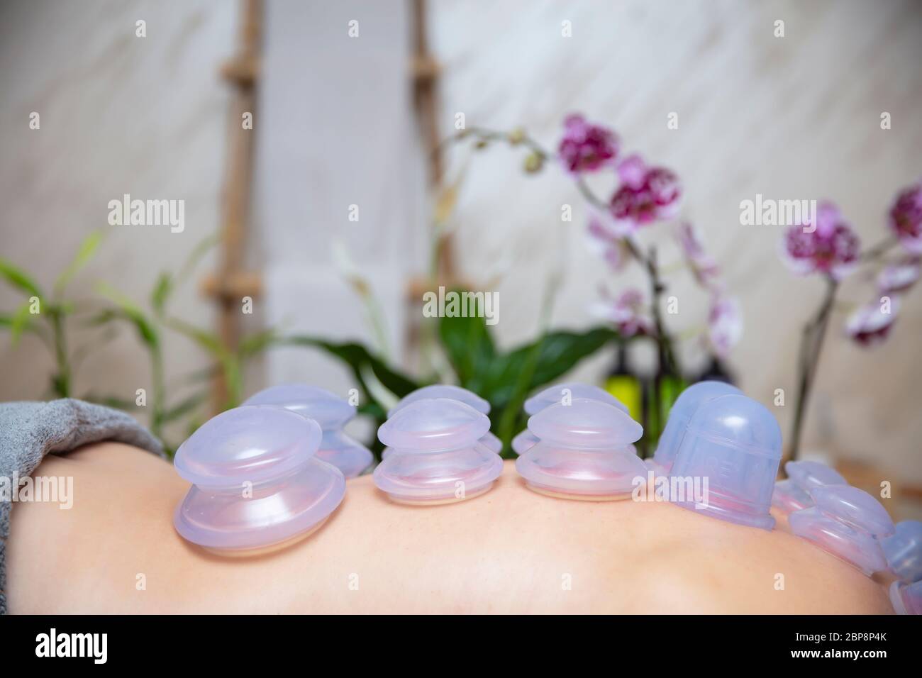 Closeup of cups applied to back skin of a female patient as part of the ...