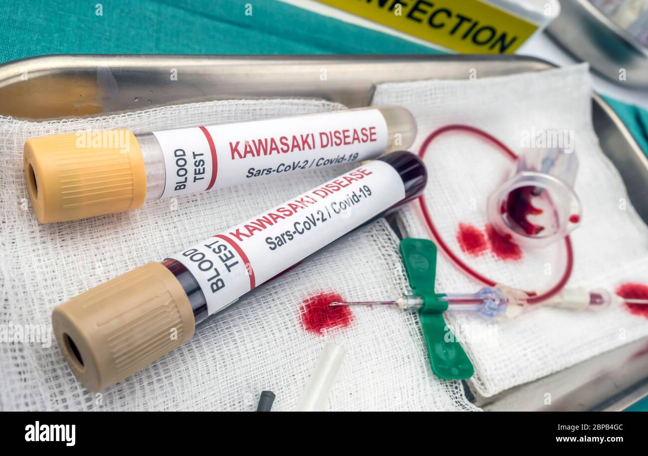 Blood samples to treat Sars-CoV-2-related Kawasaki disease in children ...