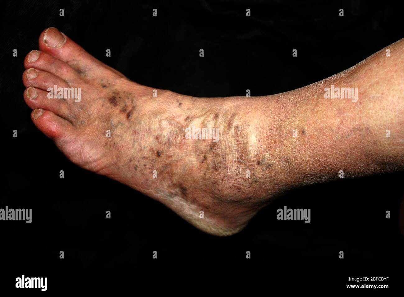 Leg. Varicose veins. Phlebeurysm. Thrombophlebitis. leg in veins Stock ...