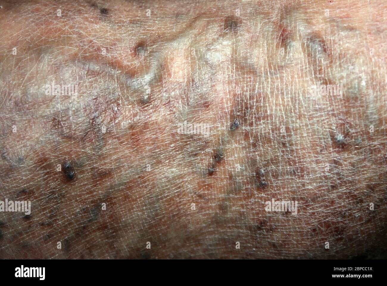 Varicose veins. Phlebeurysm. Thrombophlebitis. leg in veins Stock Photo ...