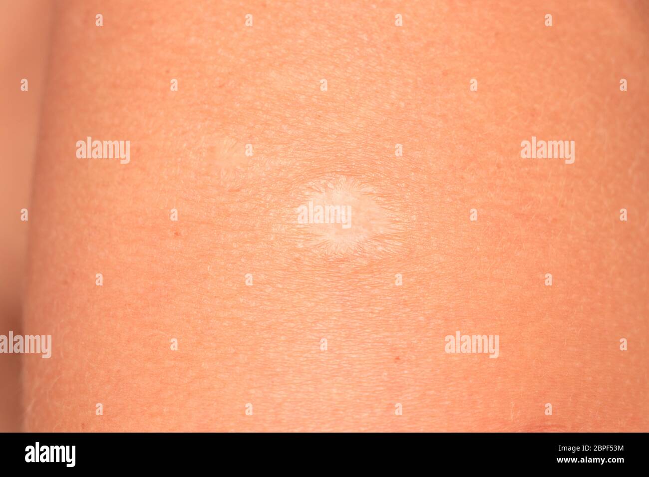Vaccine Scar High Resolution Stock Photography and Images - Alamy