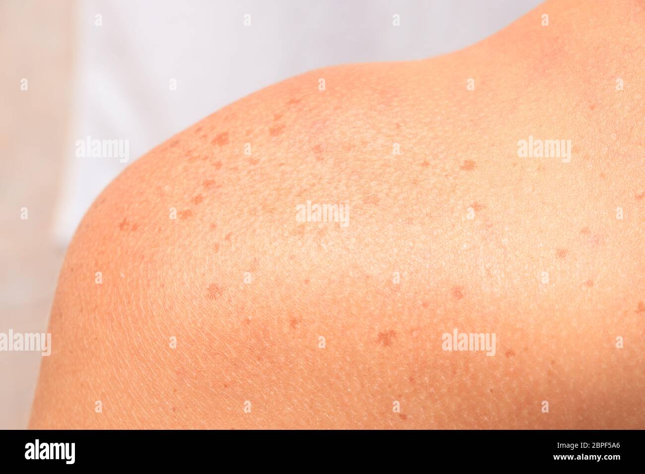 Skin of a womans shoulder with birthmarks Stock Photo - Alamy