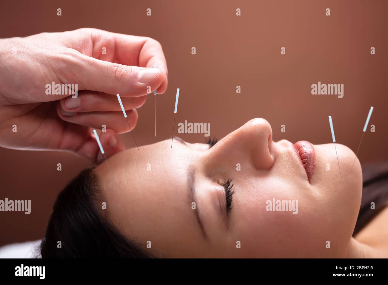 Close-up Of A Woman's Face Receiving Acupuncture Treatment On Her Face ...