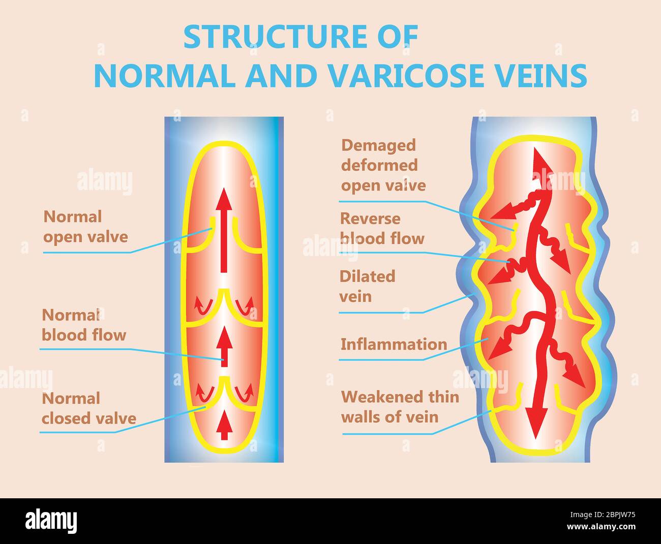 The abstract varicose veins and normal veins Stock Photo - Alamy