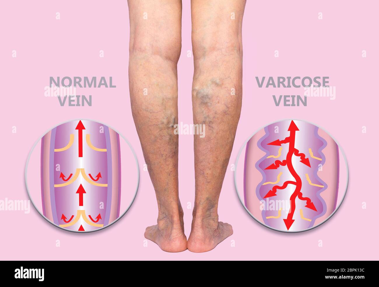 Varicose veins on a female senior legs. The structure of normal and ...