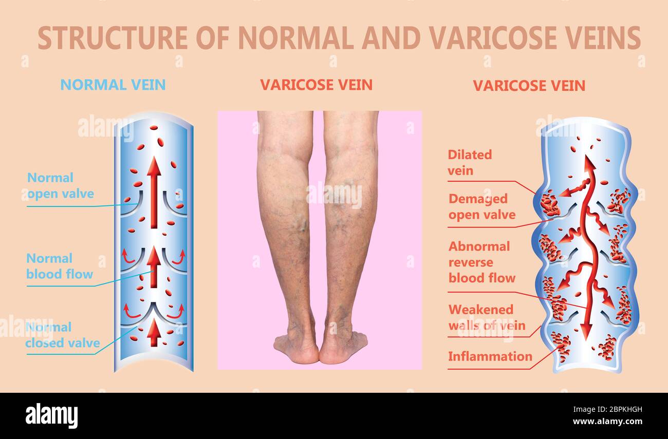 Varicose veins on a female senior legs. The structure of normal and ...