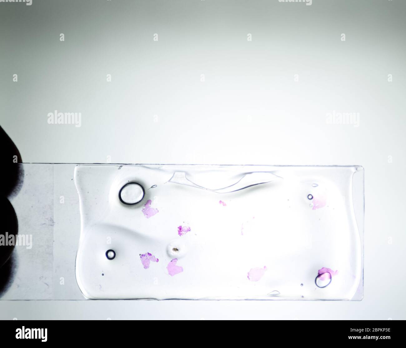 Slices of the tumor under glass. Histological examination of tumor ...