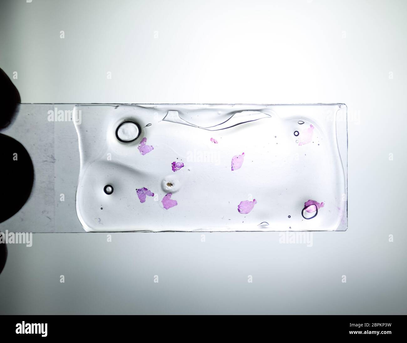 Slices of the tumor under glass. Histological examination of tumor ...