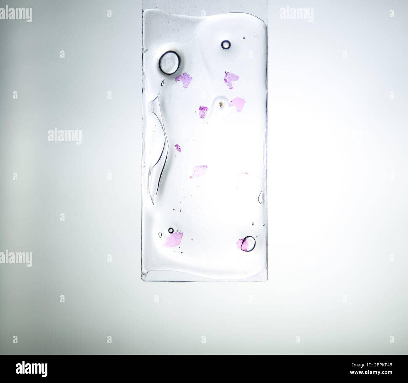 Slices of the tumor under glass. Histological examination of tumor ...