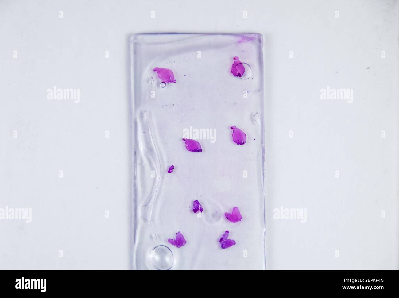 Slices of the tumor under glass. Histological examination of tumor ...