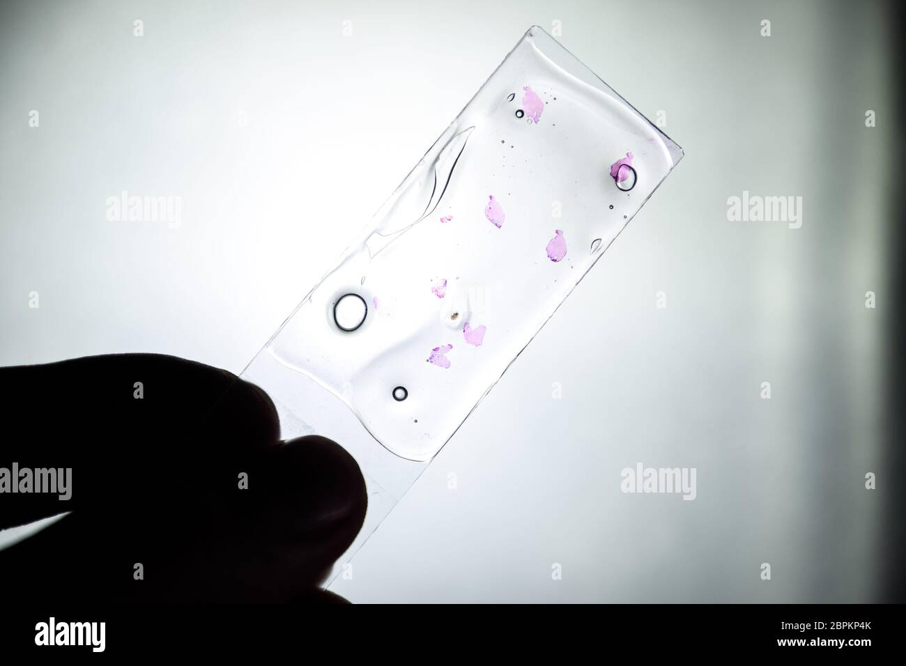 Slices of the tumor under glass. Histological examination of tumor ...