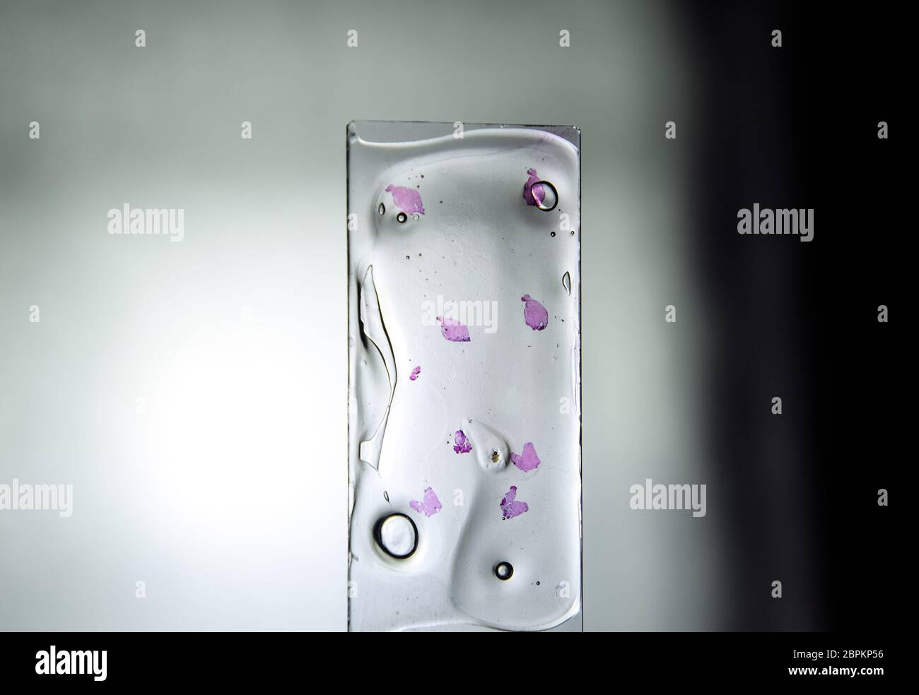 Slices of the tumor under glass. Histological examination of tumor ...