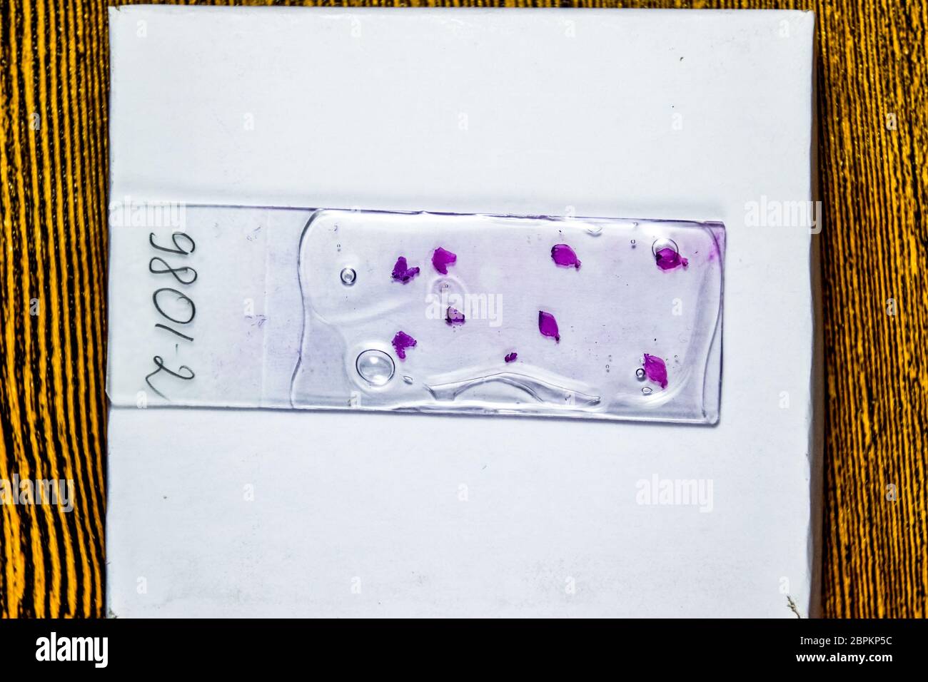 Slices of the tumor under glass. Histological examination of tumor ...