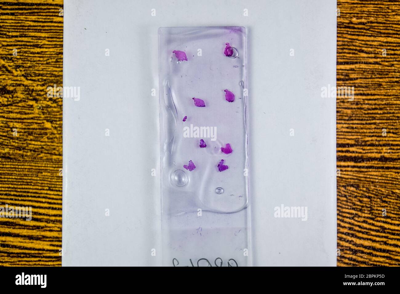 Slices of the tumor under glass. Histological examination of tumor ...