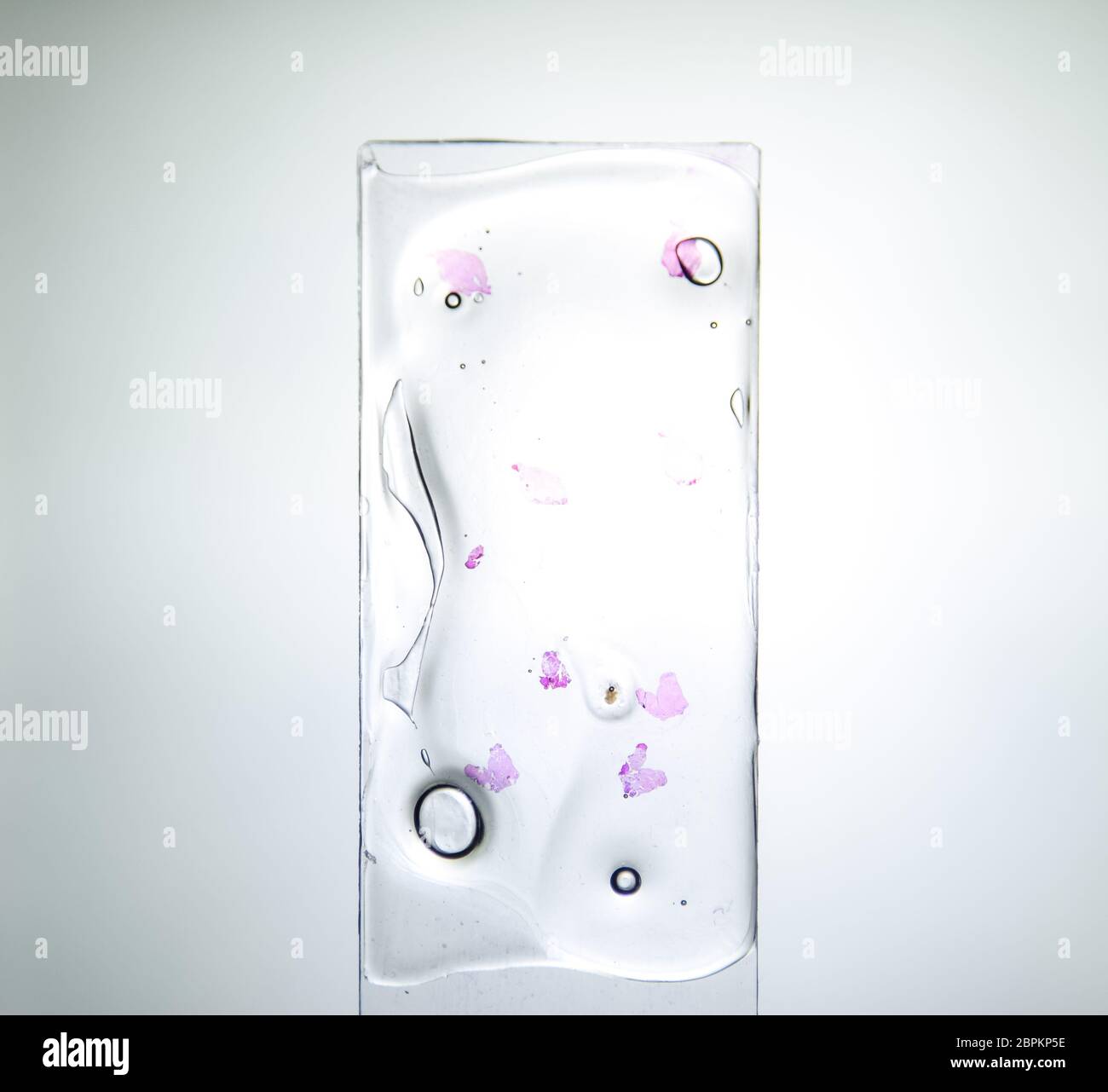 Slices of the tumor under glass. Histological examination of tumor ...