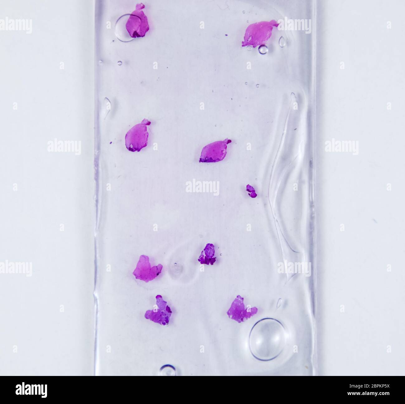 Slices of the tumor under glass. Histological examination of tumor ...