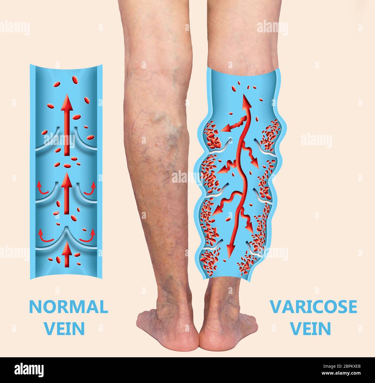Varicose veins on a female senior legs. The structure of normal and ...