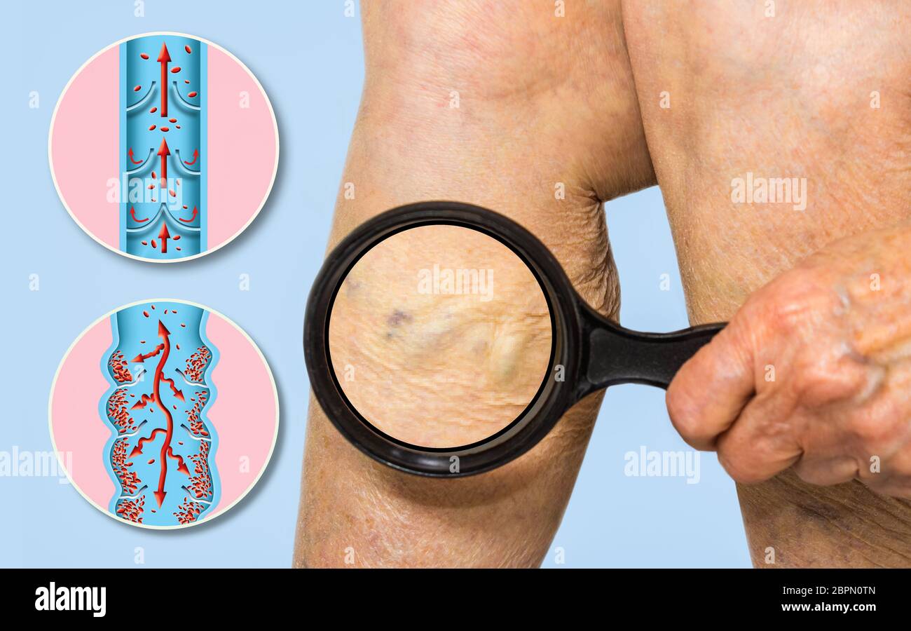 Varicose veins on a female senior legs. The structure of normal and ...