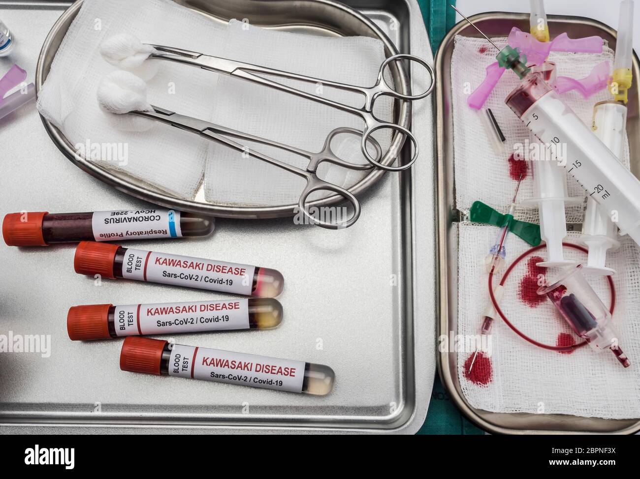 Blood samples to treat Sars-CoV-2-related Kawasaki disease in children ...