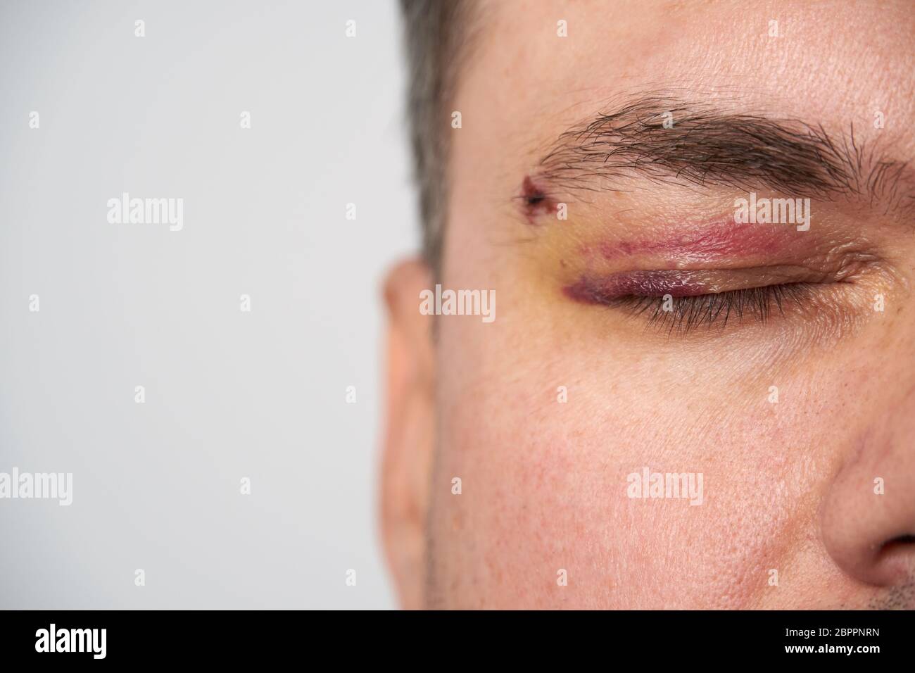 close view of a bruise near the eye, the face of a man with a hematoma ...