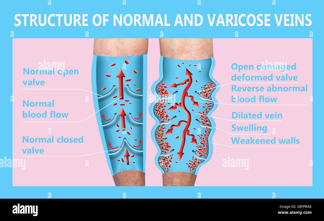 Varicose veins on a female senior legs. The structure of normal and ...