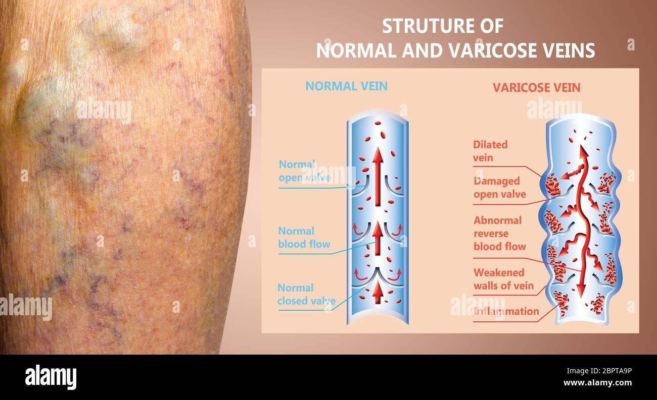 Varicose veins on a female senior legs. The structure of normal and ...