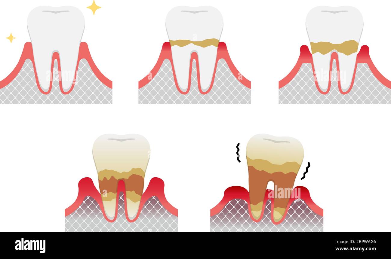 The stages of periodontitis disease vector illustration Stock Vector ...