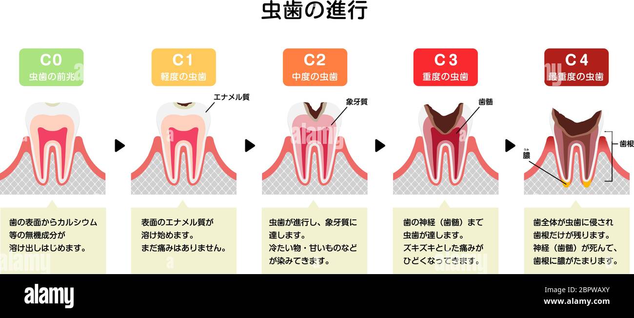 The stages of tooth decay / flat vector illustration (Japanese Stock ...