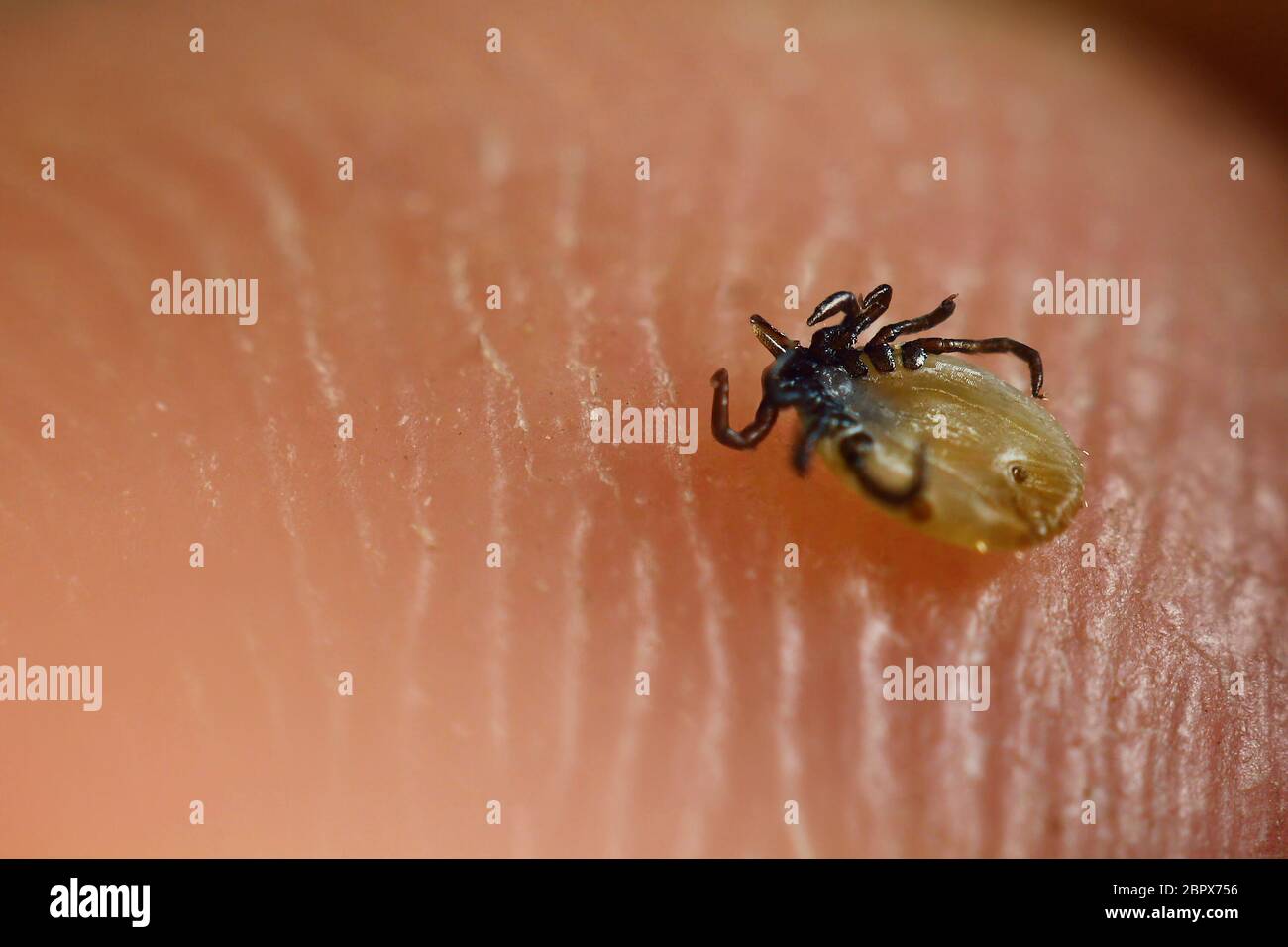 Tick closeup on human skin after being extracted Stock Photo - Alamy