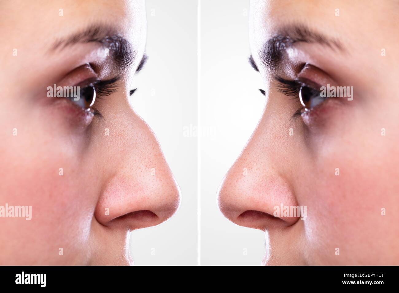 Woman's Nose Before And After Plastic Surgery With Red And Green Arrows ...