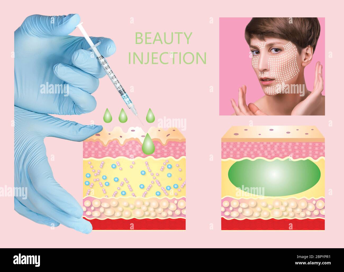 Cosmetic or dermal fillers. Young female with clean fresh skin ...