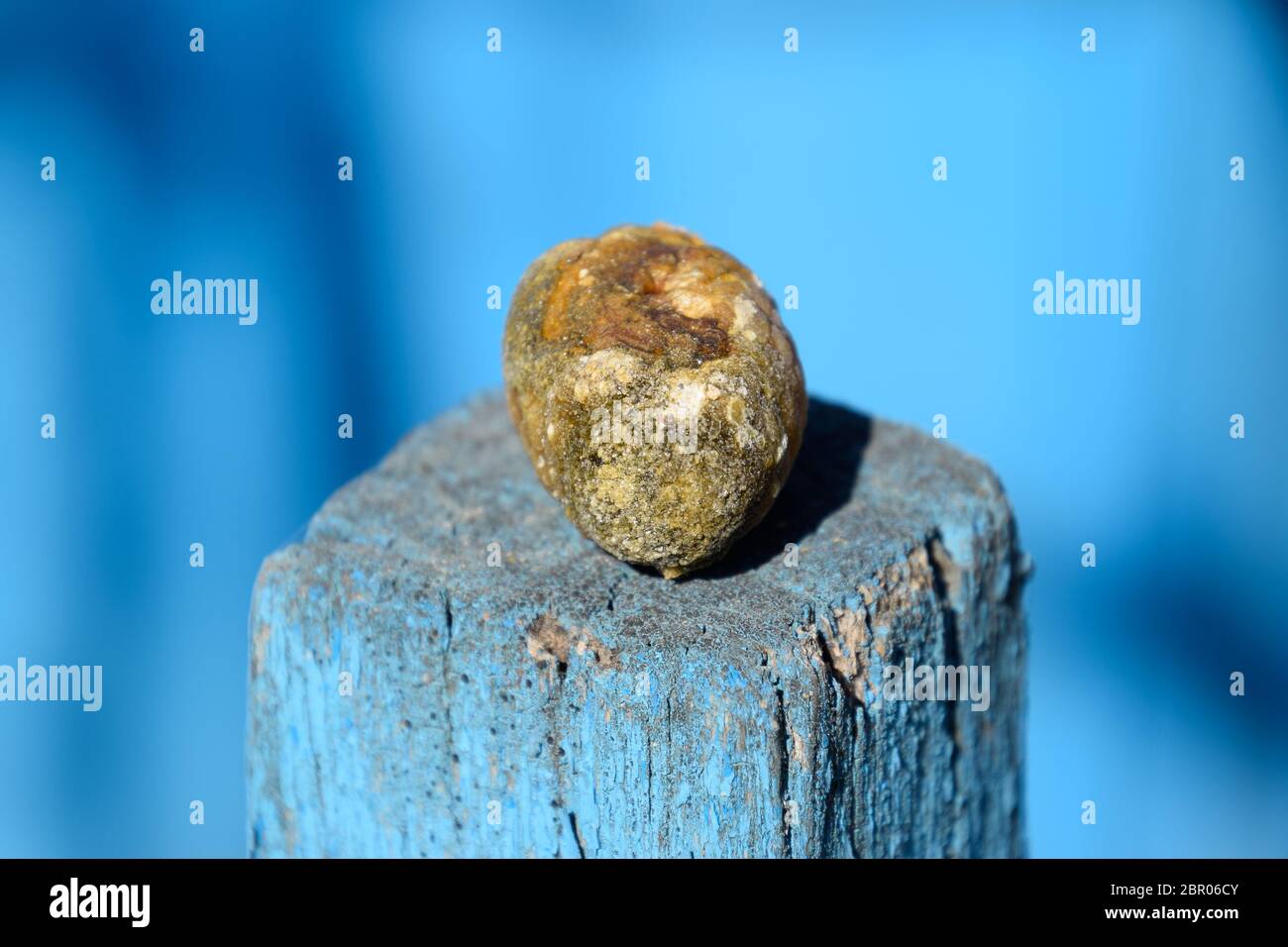Gall bladder stone. The result of gallstones. Calculus of heterogeneous ...