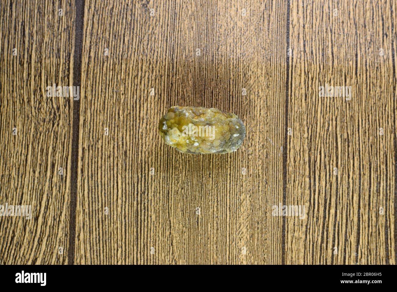 Large gallstone, Gall bladder stone. The result of gallstones. Calculus ...